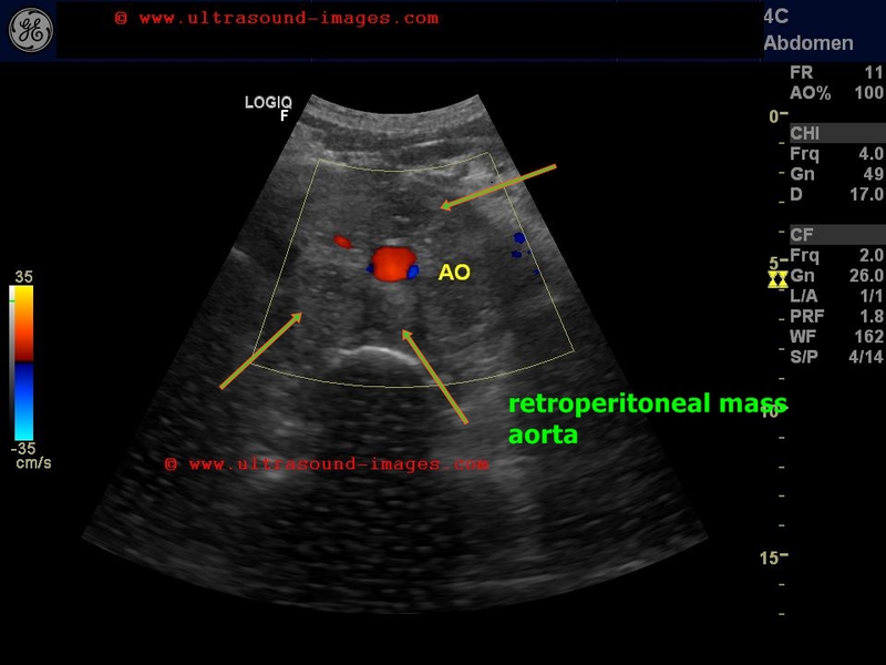 Shotty retroperitoneal lymph nodes - tyredmorning